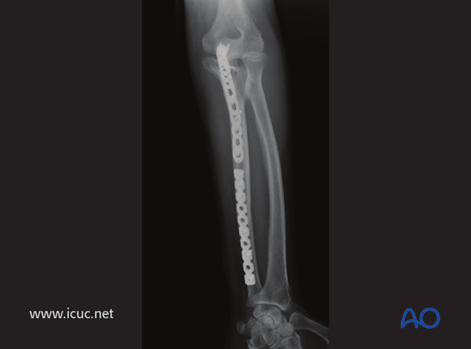 Open reduction internal fixation for Anterior transolecranon fracture ...