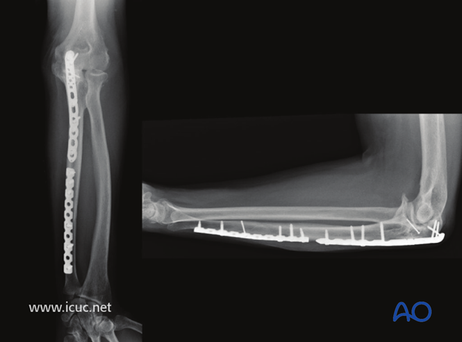 Open reduction internal fixation for Anterior transolecranon fracture ...