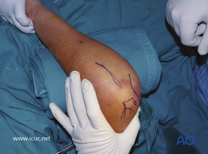 Tension band wiring for Ulna, articular, olecranon