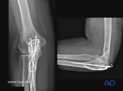 Tension band wiring for Ulna, articular, olecranon