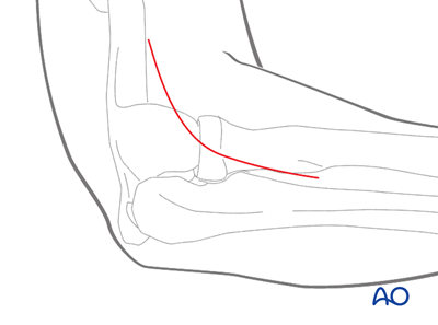 Lateral approach to the proximal radius