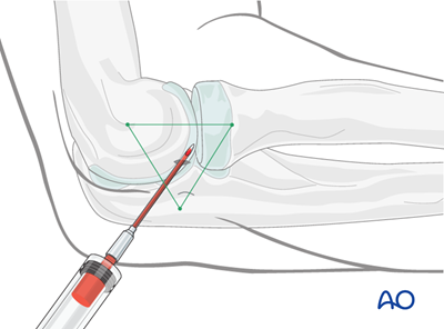 Nonoperative for Ulna, articular, coronoid