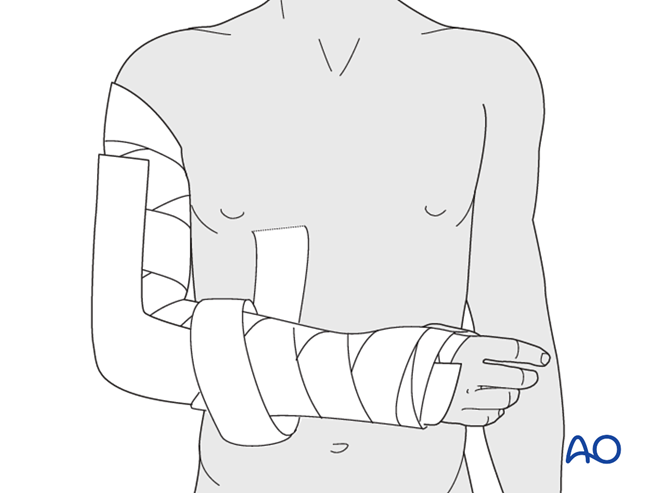 Nonoperative for Ulna, articular, coronoid