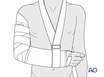 Repair of coronoid fracture for Ulna, articular, coronoid