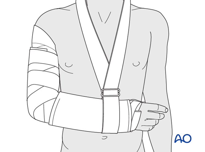 Repair of coronoid fracture for Ulna, articular, coronoid