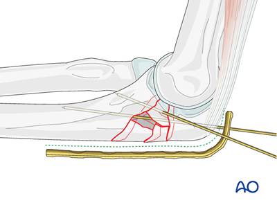 Bridge plate for Ulna, articular, olecranon