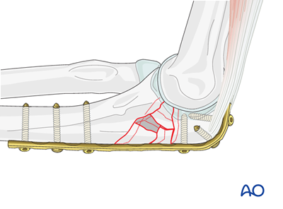 Bridge plate for Ulna, articular, olecranon