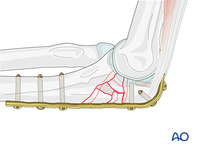 Bridge plate for Ulna, articular, olecranon