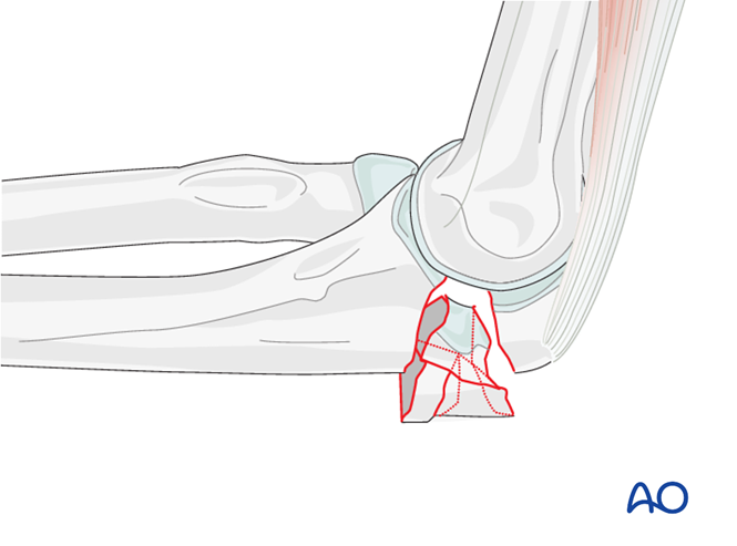 Bridge plate for Ulna, articular, olecranon