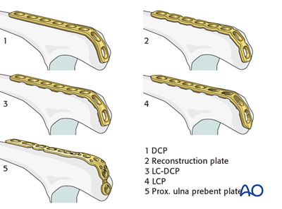 Bridge plate for Ulna, complete articular