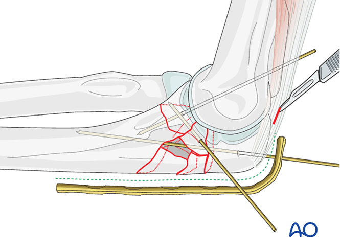 Bridge plate for Ulna, complete articular