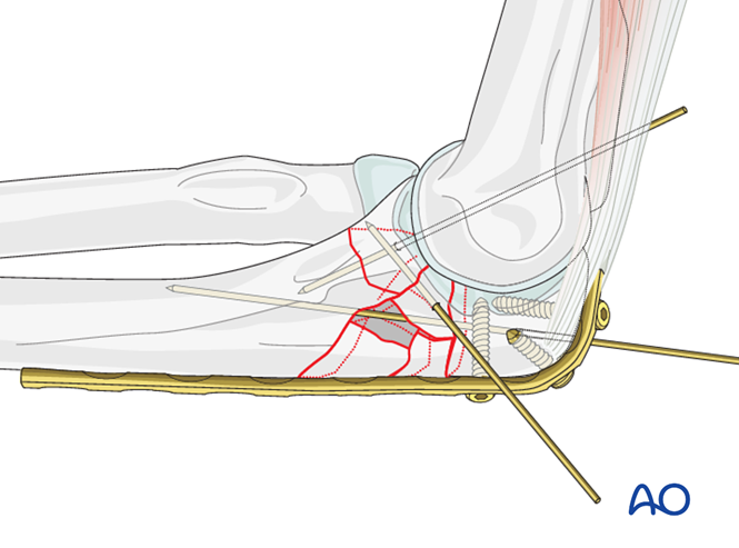 Bridge plate for Ulna, complete articular