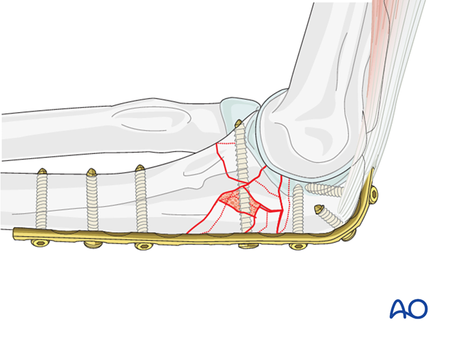 Bridge plate for Ulna, complete articular