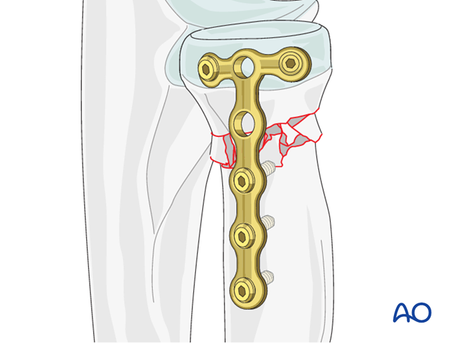 Bridge plate for Radius, extraarticular, multifragmentary