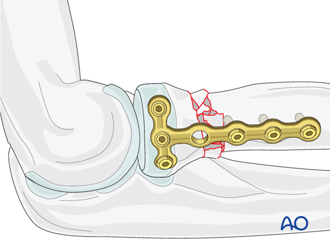 Bridge plate for Radius, extraarticular, multifragmentary