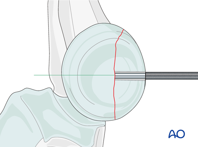 Lag screw for Radius, partial articular