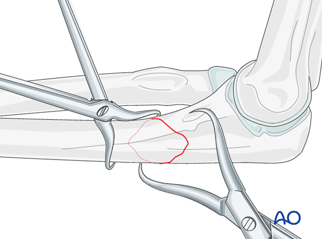 Lag screw and protection plate for Ulna, extraarticular, simple