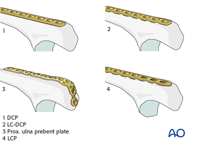 Lag screw and protection plate for Ulna, extraarticular, simple