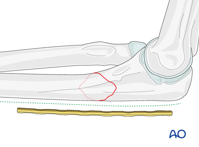 Lag screw and protection plate for Ulna, extraarticular, simple