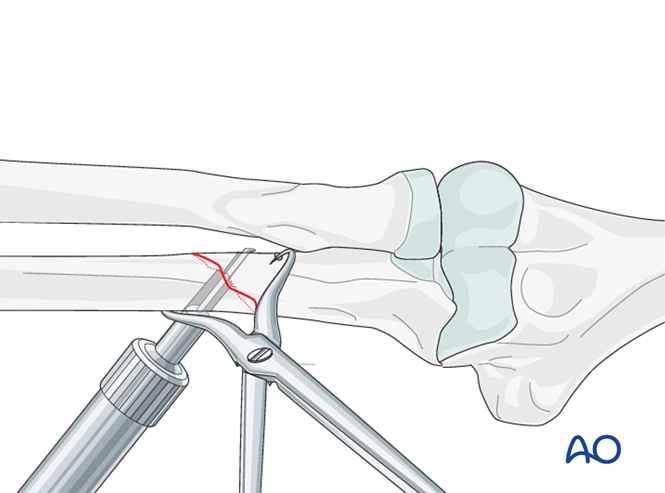 Lag screw and protection plate for Ulna, extraarticular, simple