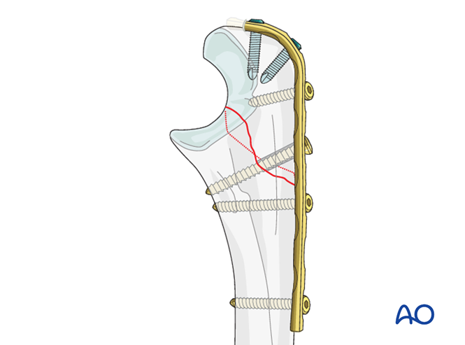 Lag screw with neutralization plate for Ulna, articular, olecranon