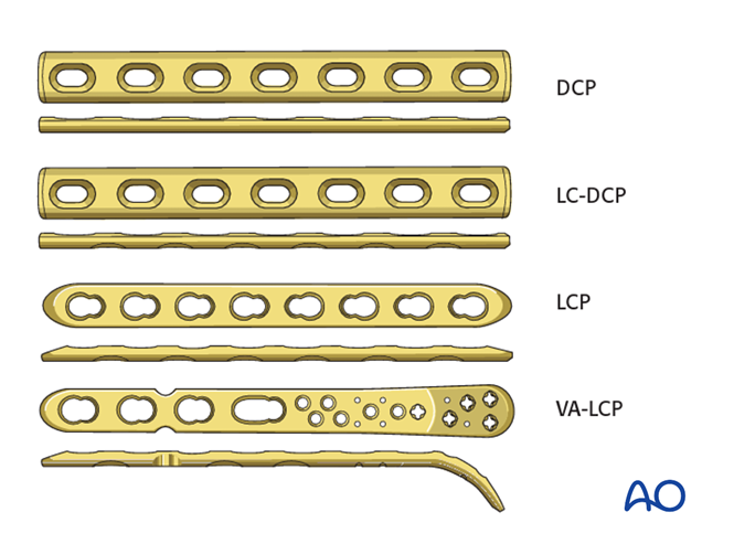 Ulna, articular, olecranon, simple - Plate with or without lag screw