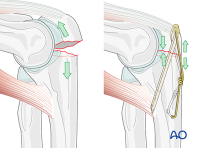 Tension band wiring for Ulna, articular, olecranon