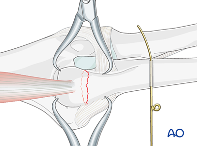 Tension band wiring for Ulna, articular, olecranon