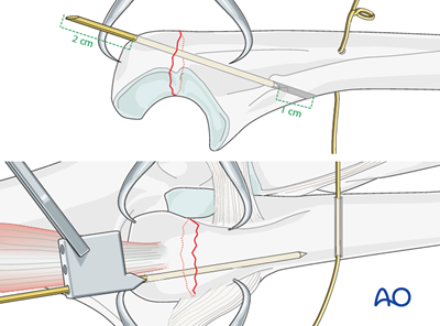Tension band wiring for Ulna, articular, olecranon
