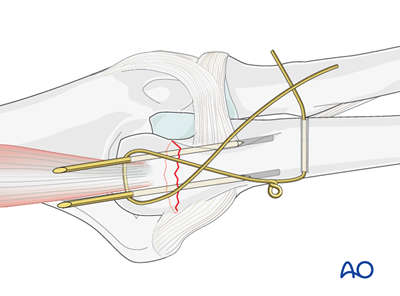 Tension band wiring for Ulna, articular, olecranon