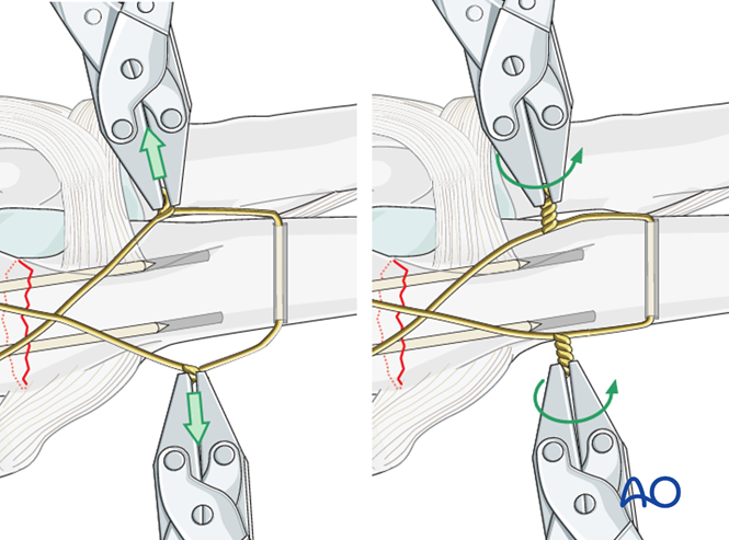 Tension band wiring for Ulna, articular, olecranon