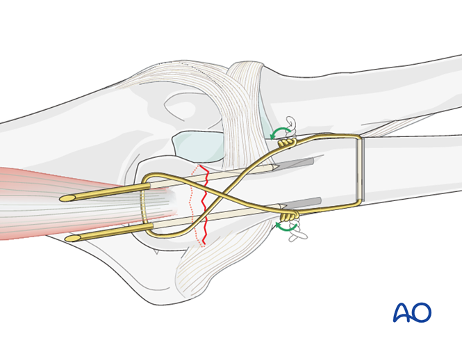 Tension band wiring for Ulna, articular, olecranon