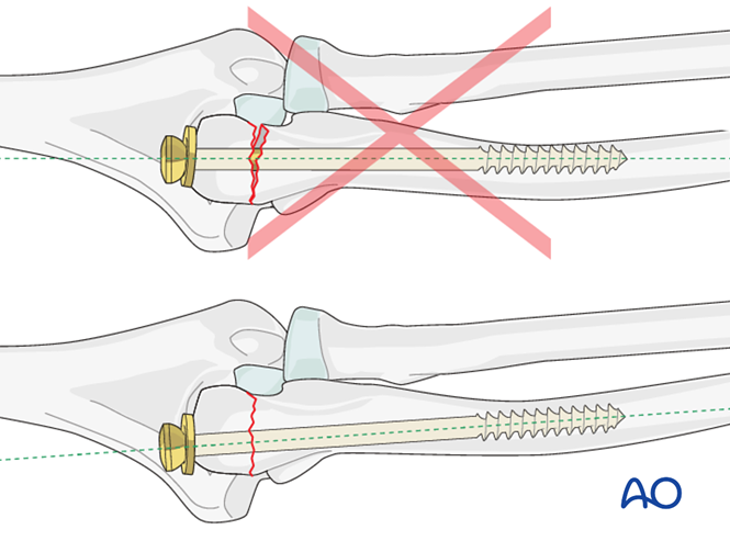 Tension band wiring for Ulna, articular, olecranon