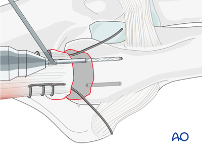 Triceps reinsertion for Ulna, extraarticular, avulsion of triceps insertion