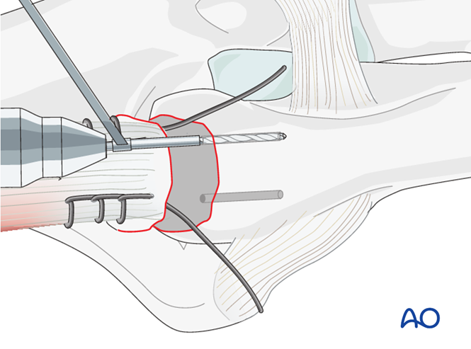 Triceps reinsertion for Ulna, extraarticular, avulsion of triceps insertion