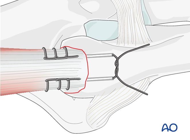 Triceps reinsertion for Ulna, extraarticular, avulsion of triceps insertion
