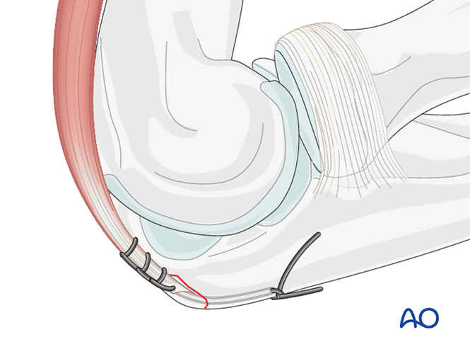 Triceps reinsertion for Ulna, extraarticular, avulsion of triceps insertion