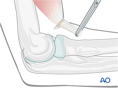 Biceps reinsertion for Radius, extraarticular, avulsion of bicipital ...