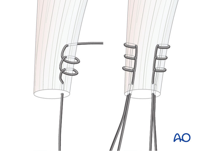 Biceps reinsertion for Radius, extraarticular, avulsion of bicipital ...