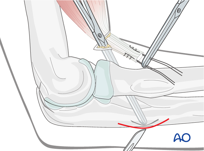 Biceps reinsertion for Radius, extraarticular, avulsion of bicipital ...