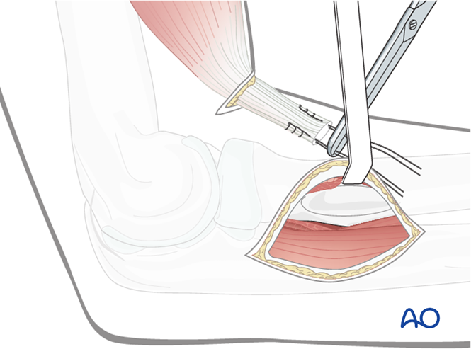 Biceps reinsertion for Radius, extraarticular, avulsion of bicipital ...