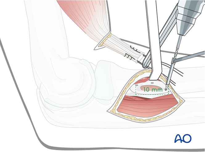 Biceps reinsertion for Radius, extraarticular, avulsion of bicipital ...