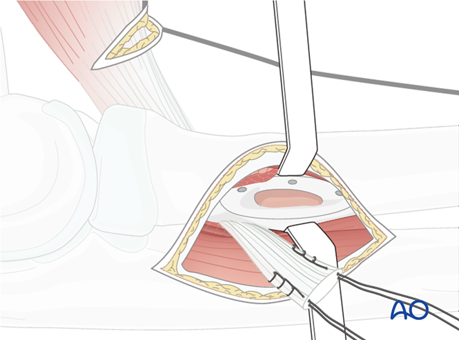 Biceps reinsertion for Radius, extraarticular, avulsion of bicipital ...