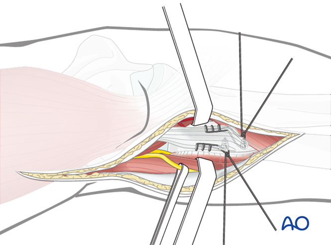 Biceps reinsertion for Radius, extraarticular, avulsion of bicipital ...