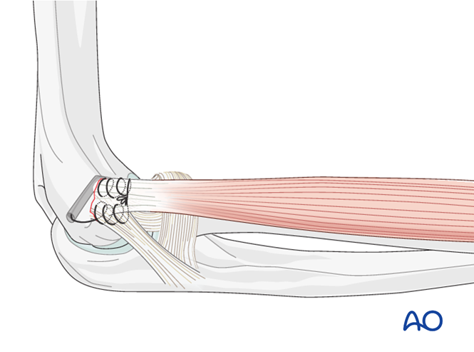 Repair of lateral collateral ligaments