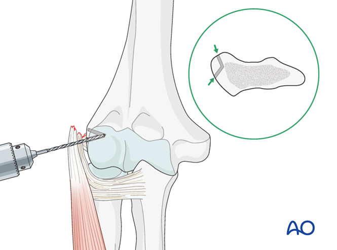 Repair of lateral collateral ligaments