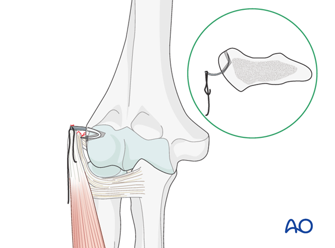 Repair of lateral collateral ligaments