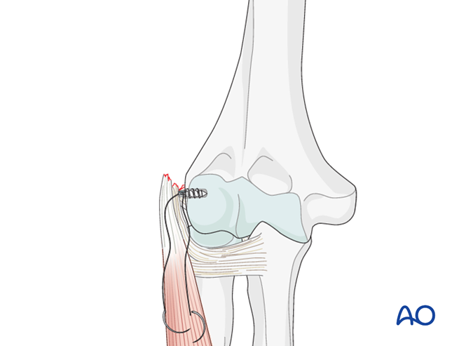 Repair of lateral collateral ligaments