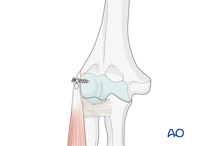 Repair of lateral collateral ligaments