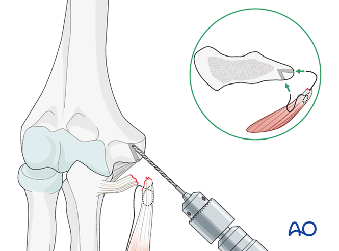 Repair of medial collateral ligament